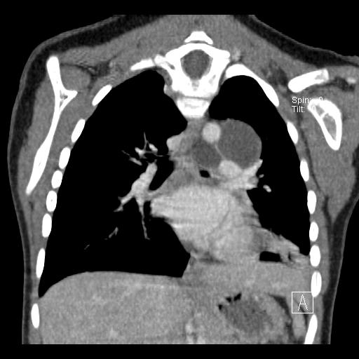 Foregut Duplication cyst | Pediatric Laparoscopy