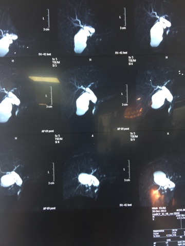 Hepatico duodenostomy for Choledochal cyst | Pediatric Laparoscopy